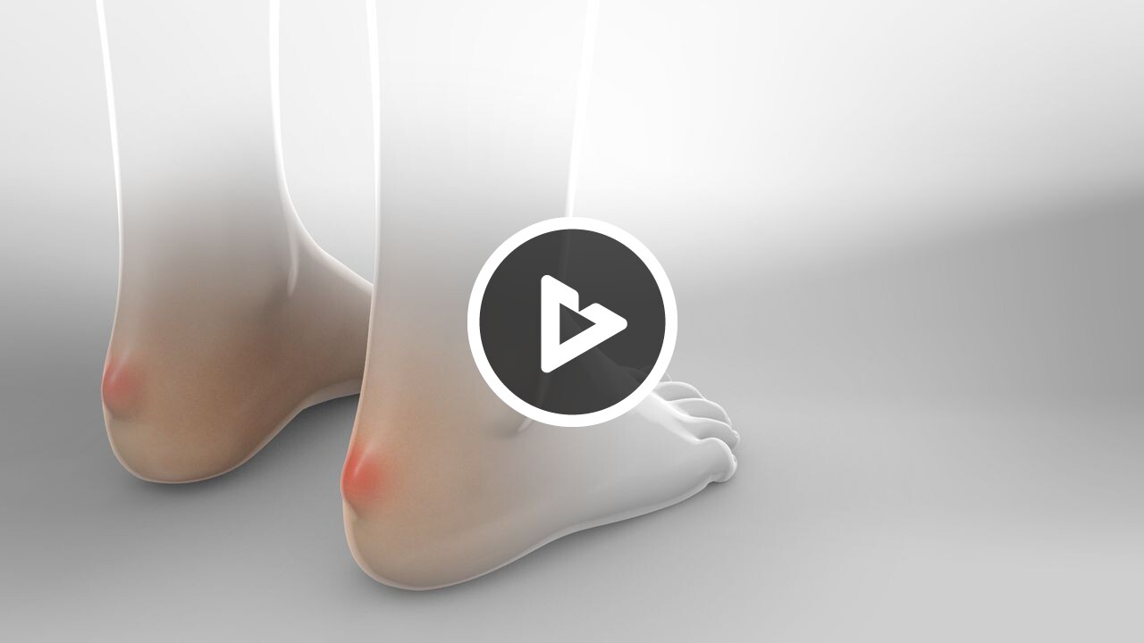Haglund's Deformity (Retrocalcaneal Bursitis) - Disease & Condition ...